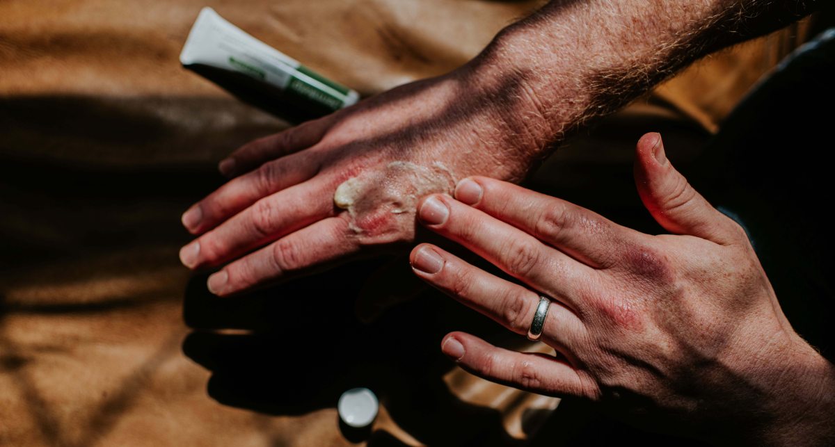 6 common types of burns and how to care for them | PeaceHealth